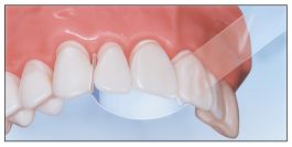 Premier Stop Strips Anterior 8mm 100/pk